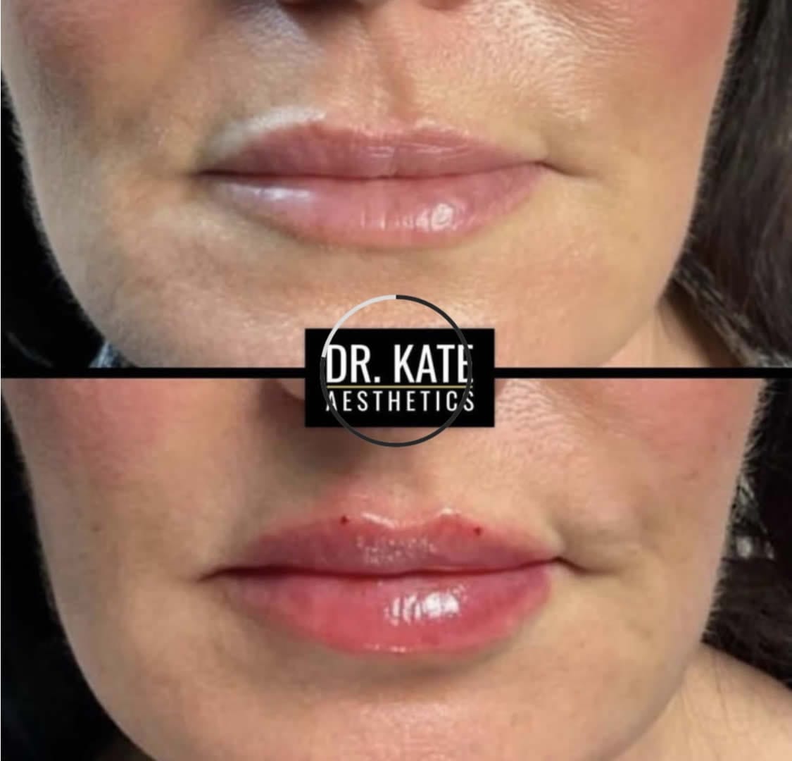 Before And Afters: Lip Fillers | Aesthetics & Skin Care Clinic in North ...