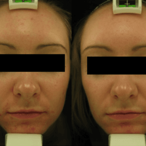 LED Phototherapy - Skin Rejuvenation | Barnet Clinic